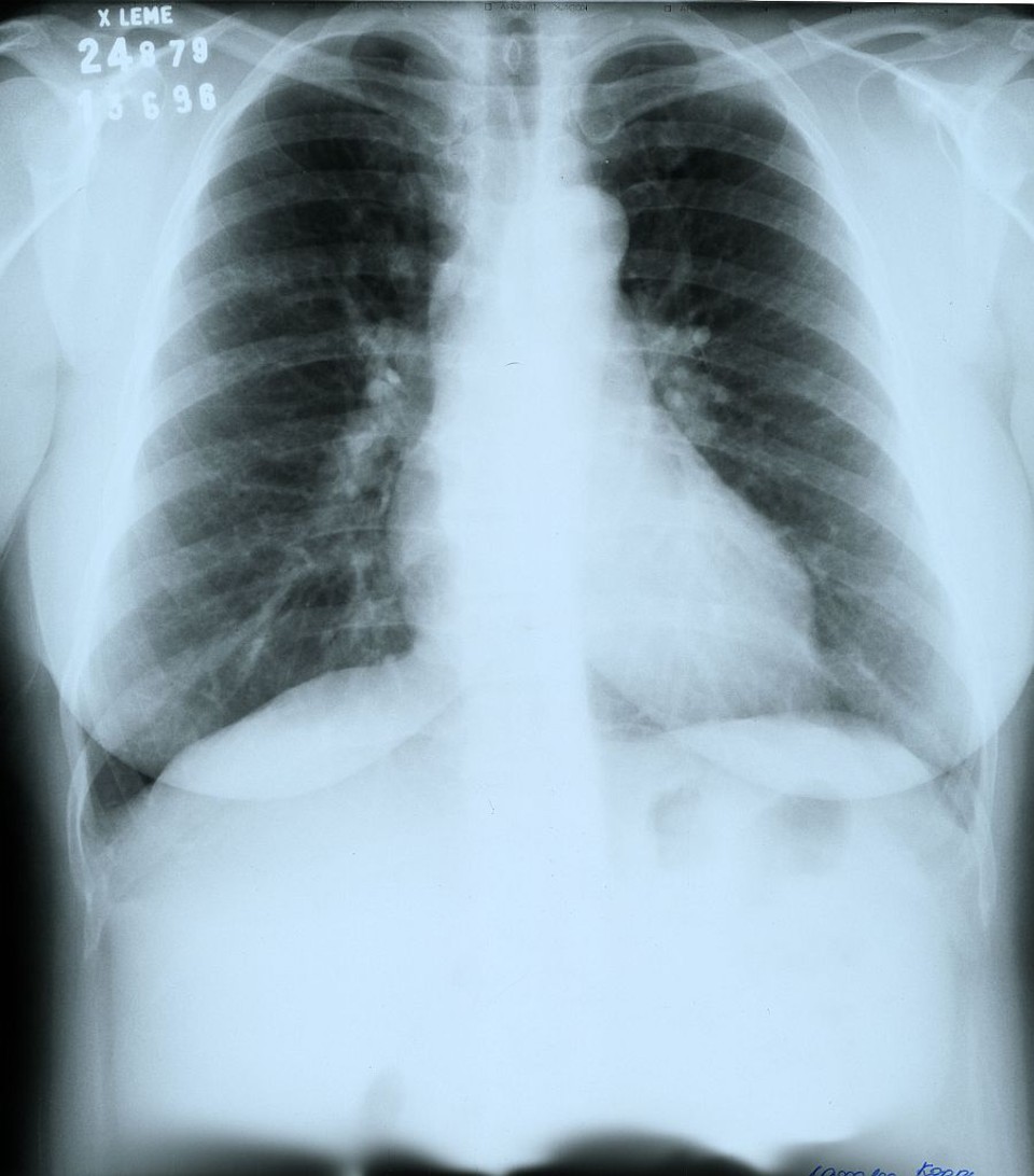 Raio X Dos Pulmoes Da Tuberculose Coleta De Tuberculose Pulmonar.