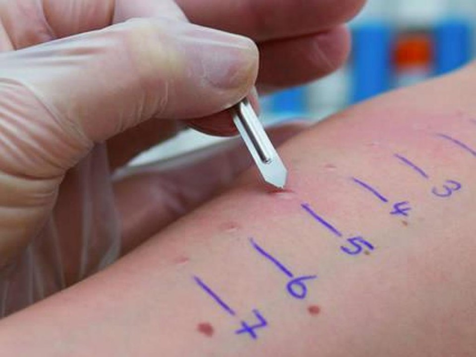 Curitiba terá consultas e testes de alergia gratuitos