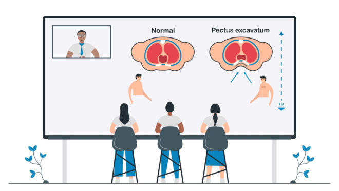 O que é pectus excavatum? Conheça diferentes tipos de peito escavado