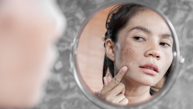 Melasma no rosto: saiba o que são as manchas escuras na pele