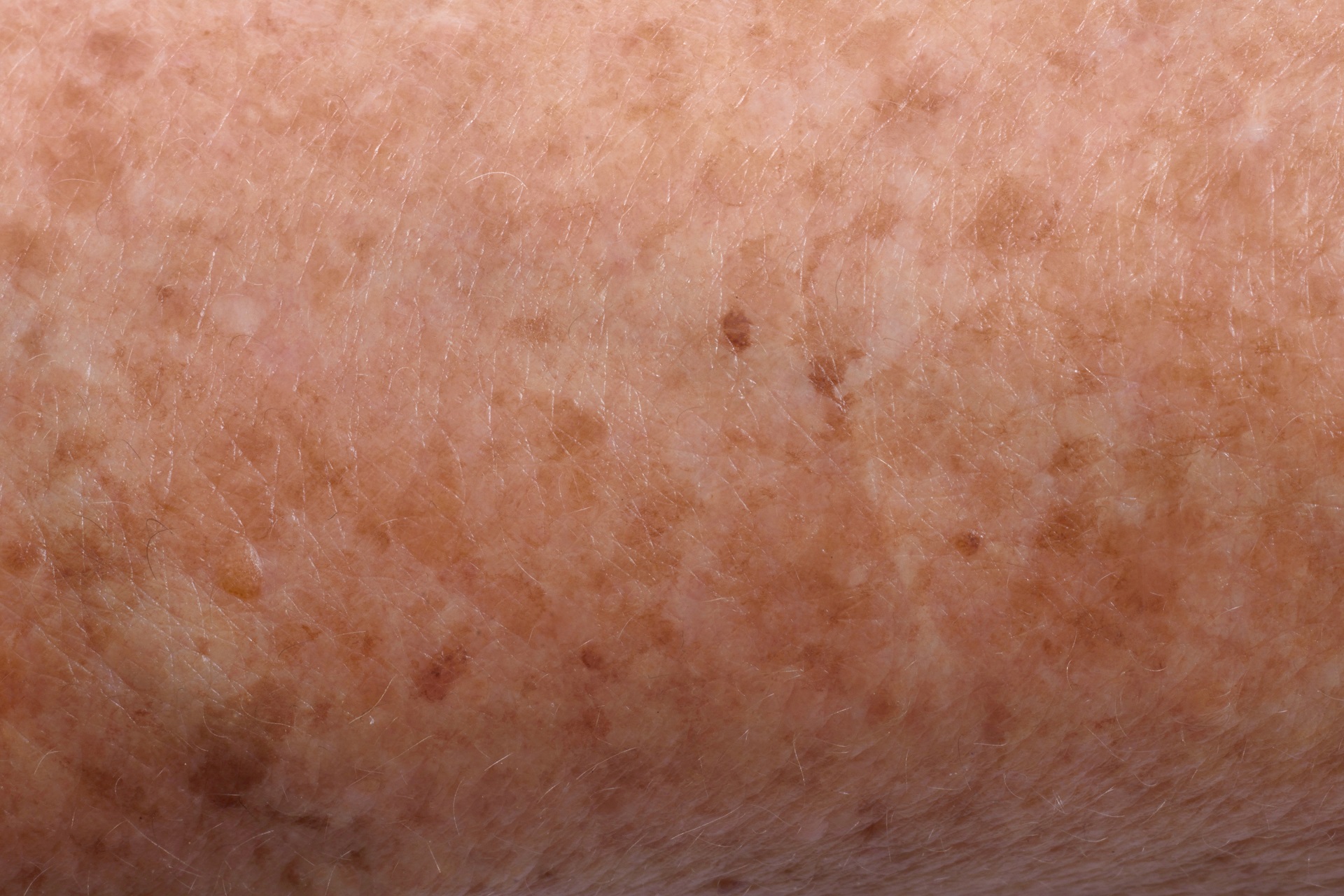 Manchas vermelhas comuns em idosos podem evoluir para câncer de pele